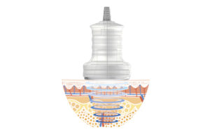 μείωση τοπικού λίπους | Megason | Ouzounis Medical